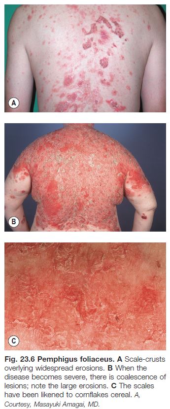 Pemphigus Foliaceus And Acquired Haemophilia A Rare But 48 Off