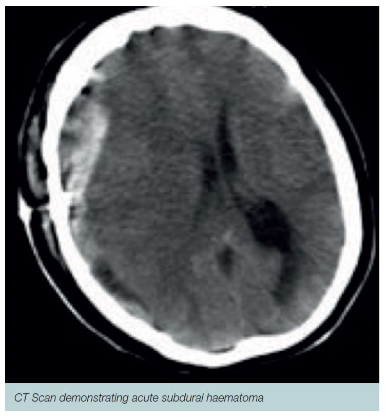 Acute Subdural Hematoma